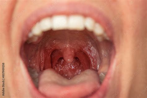 The Woman Suffers From Pharyngitis Red Sore Throat Caused By Infections And Viruses Close Up