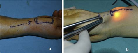 Photography Of Marked Surgical Landmarks For Releasing The First