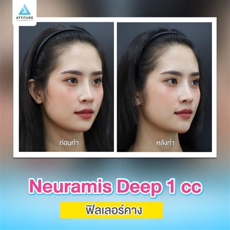 ฉีดฟิลเลอร์คางที่ Attitude Clinic ปรับรูปหน้าให้เรียวสวยได้ดั่งใจ