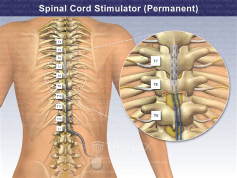 Spinal Cord Stimulator Permanent