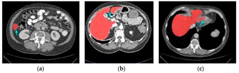 apestnet with mask r cnn for liver tumor segmentation and classification