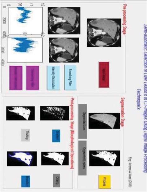 Figure 11 From Detection Of Ct Liver Lesions Using Otsu Algorithm And Morphological Operations