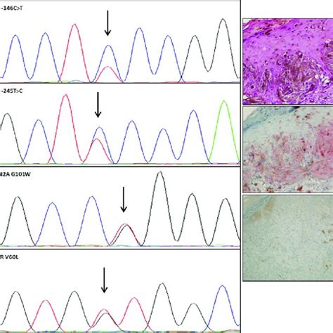 Somatic And Germline Mutations And Variants In One Representative Case