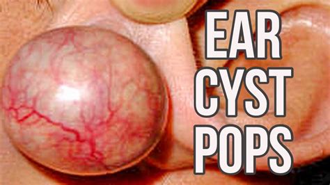 Earlobe Sac Cyst Busting Educational Ear Bumps Popped YouTube