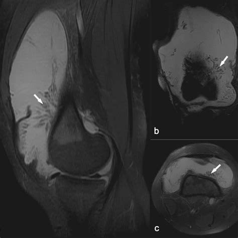 23 Year Old Female With Lipoma Arborescens Of The Right Knee Joint