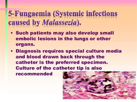 Malassezia Infection