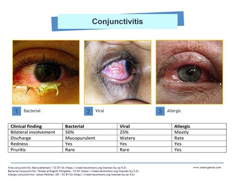 Conjunctivitis Reeldx Lecture Smarty Pance
