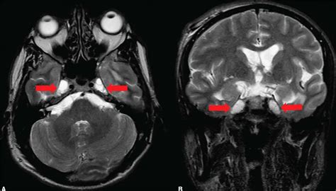 Psödotümör Serebri Nedir Ankara Masası