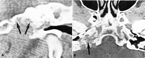 Figure 1 From Infratemporal Fossa Approach For Glomus Tumors Of The Temporal Bone Semantic Scholar