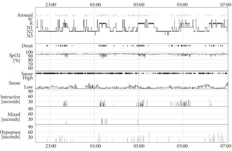 Hypnogram Shows Obstructive Sleep Apneas With Positional And Rapid Eye