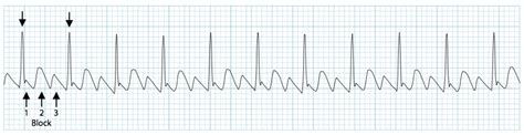 Artial Flutter Electrophysiologist Miami Dr Todd Florin 7865652400