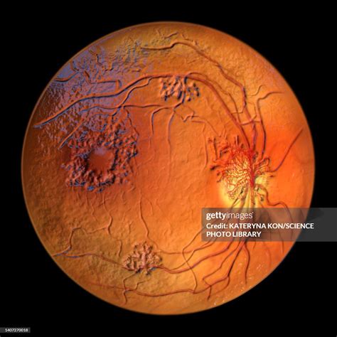 Retina Damage From Diabetes Illustration High Res Vector Graphic