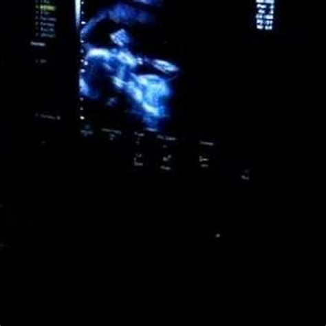 Pseudomyopia Youtube