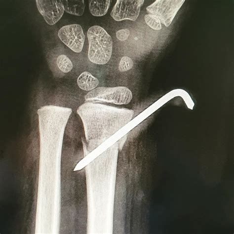 La Clásica Fractura Distal De Radio Cabalgada Que Requiere Reducción