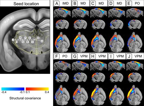 Observation Of Sharp Transitions Between Cortical Structural Covariance