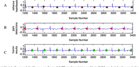 Figure 14 From Robust Heartbeat Detection Using Multimodal Recordings And Ecg Quality Assessment