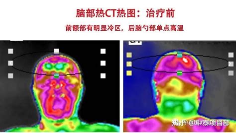 脑部热CT热图直观清晰你我也能轻松看懂热图的区别对比 知乎