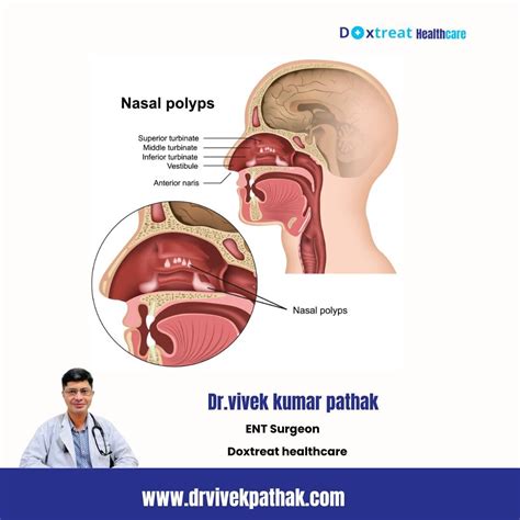 Dr Vivek Kumar Pathak On Linkedin Are You Experiencing Persistent Nasal Congestion Nasal