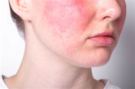 Diffuse Redness Richmond Square Medical