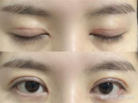 成都双眼皮面诊及术后全纪录 知乎