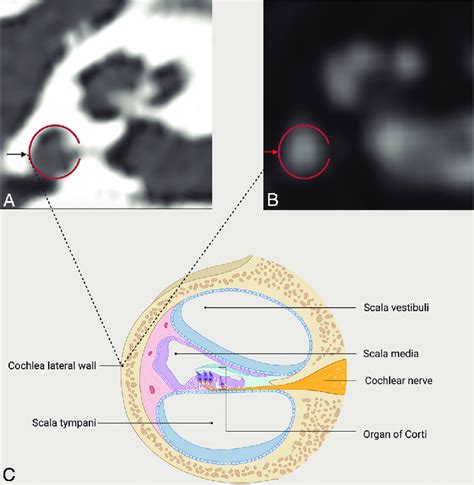 Ct A And Mr Imaging B Of The Cochlea Of The Same Patient The Red