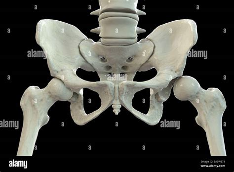 Illustration Of Hip Dysplasia Dislocation Type Showing Misalignment Of The Femoral Head And