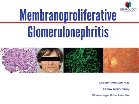 Membranoproliferative Glomerulonephritis Mpgn Chaken Pdf