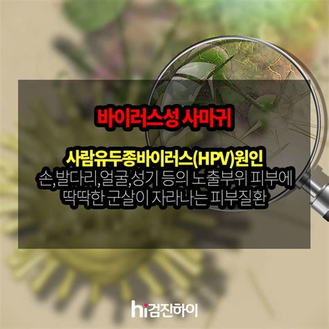 인유두종바이러스hpv감염에 의한 사마귀 바이러스성 사마귀 건강검진정보