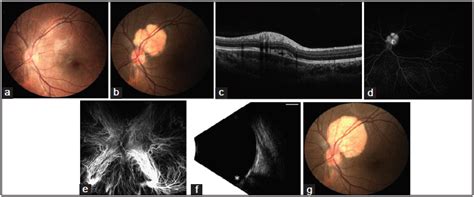 Choroidal Osteoma Oct