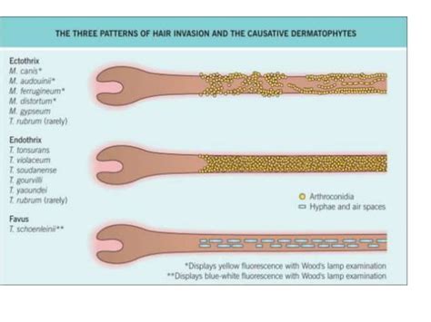 Dermatophyte Infection 2pptx