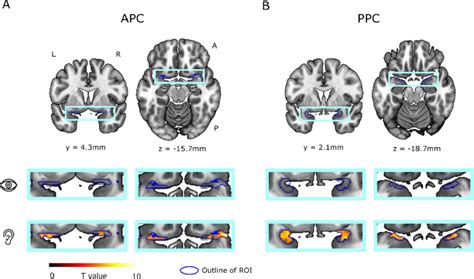 Whole Brain Mr Imaging Results A The Location Of The Anterior