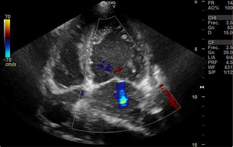 Echocardiography Features Of Non Compaction Cardiomyopathy Medicina Intensiva