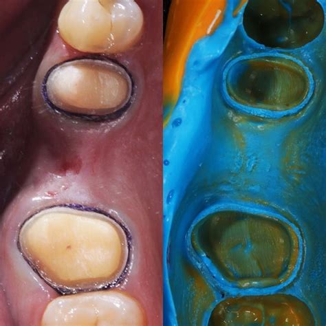 Master Impression For A Posterior Fixed Dental Prosthesis Drlokesh Sai