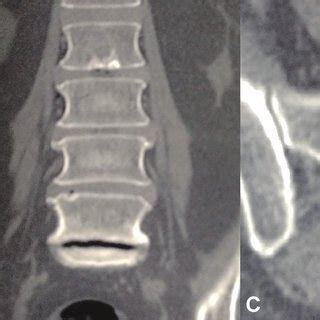 Computed Tomographic CT Scan Of The Lumbosacral Spine Showing A
