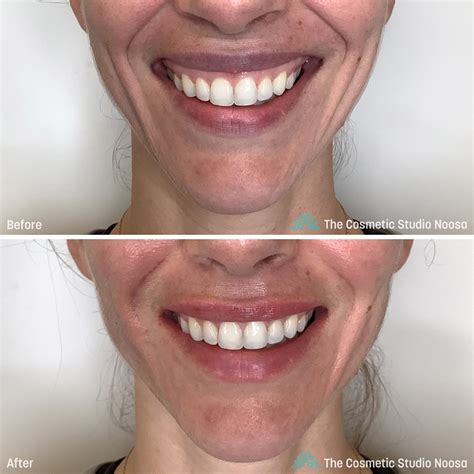 Gummy Smile Treatment The Cosmetic Studio Noosa