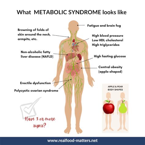 Understanding Metabolic Syndrome Diagnosis Symptoms Treatment And Risks — Karen Kennedy
