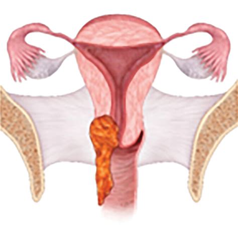 Cervix Cancer Staging