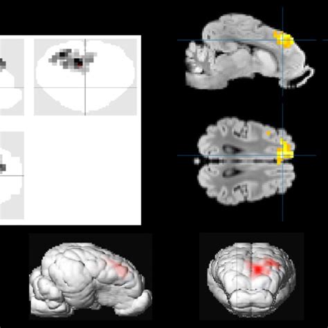 Statistical Comparison Within The Brain Glucose Metabolism Map Obtained Download Scientific