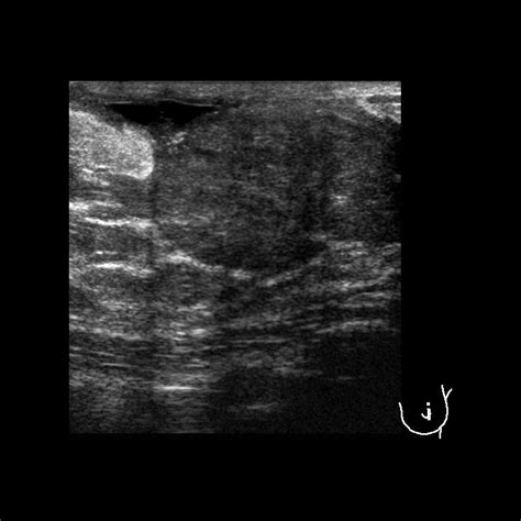 Pediatric Breast Abscess Pediatric Radiology Reference Article