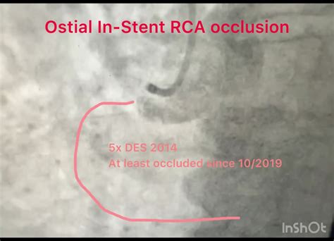 🚨 Cto Week 🫀 Rca In Stent Ostial Cto Via Retro And Antegrade Wire