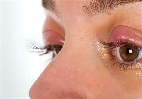 Eyelid Surgery Archives Cosmedics