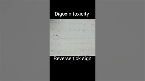 Ecg Digoxin Toxicity Youtube