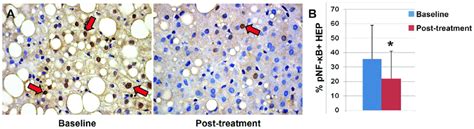 Nuclear Expression Of Phosphorylated P Nf Kb By Hepatocytes In