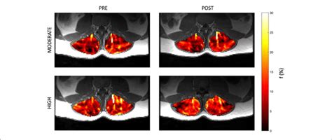 representative parameter maps of perfusion fraction f before and