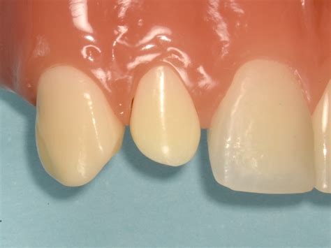 Esthetic Peg Lateral Class III Direct Restorations With Dr Vargas