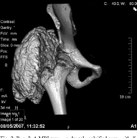 Figure 2 From Large Tumoral Calcinosis In The Gluteal Region A Case