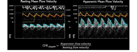 Cfr Calculation Using Doppler From Intracoronary Doppler Flow Signal