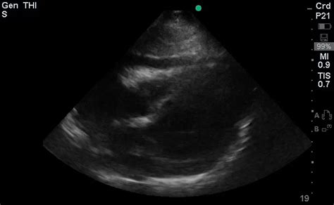 Cardiac Tamponade Tags Differential Diagnosis Of