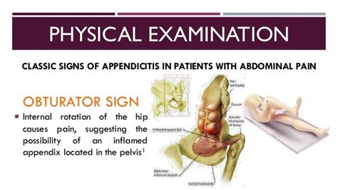 Acute Appendicitis