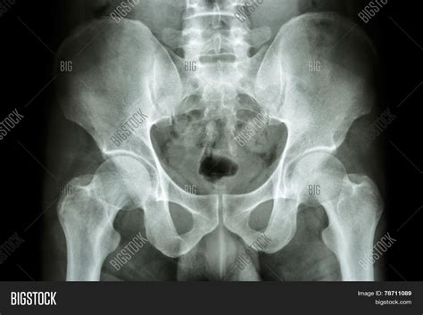 Human S Pelvis Hip Image Photo Free Trial Bigstock